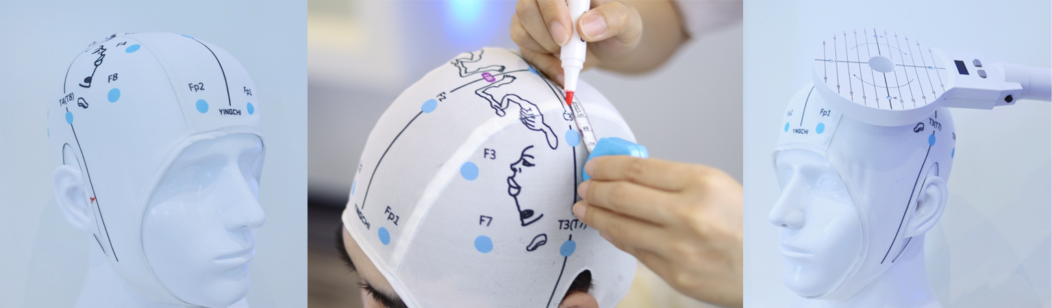 How Is YINGCHI Transcranial Magnetic Stimulation (TMS) Positioned ...