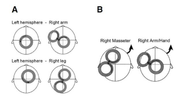 The importance of TMS coil placement