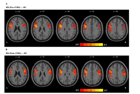 Mechanisms of Neuromodulation Technology - Advanced TMS Manufacturer