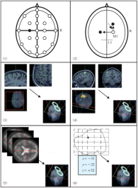 Ways to improve the treatment effect of TMS- Spatial precision ...