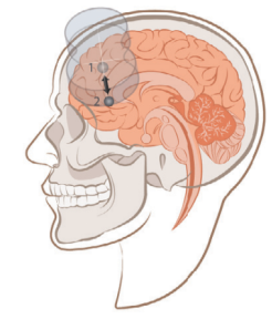 IF=17.7 | Sustained Efficacy of Stanford neuroregulatory Therapy (SNT ...