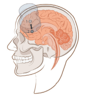 SAINT therapy can significantly alleviate symptoms in 90% of patients ...